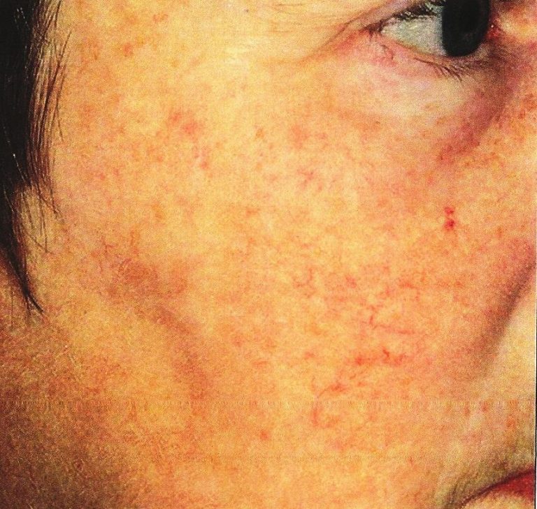 Intense Pulsed Light - Los Angeles, CA | Sand Institute